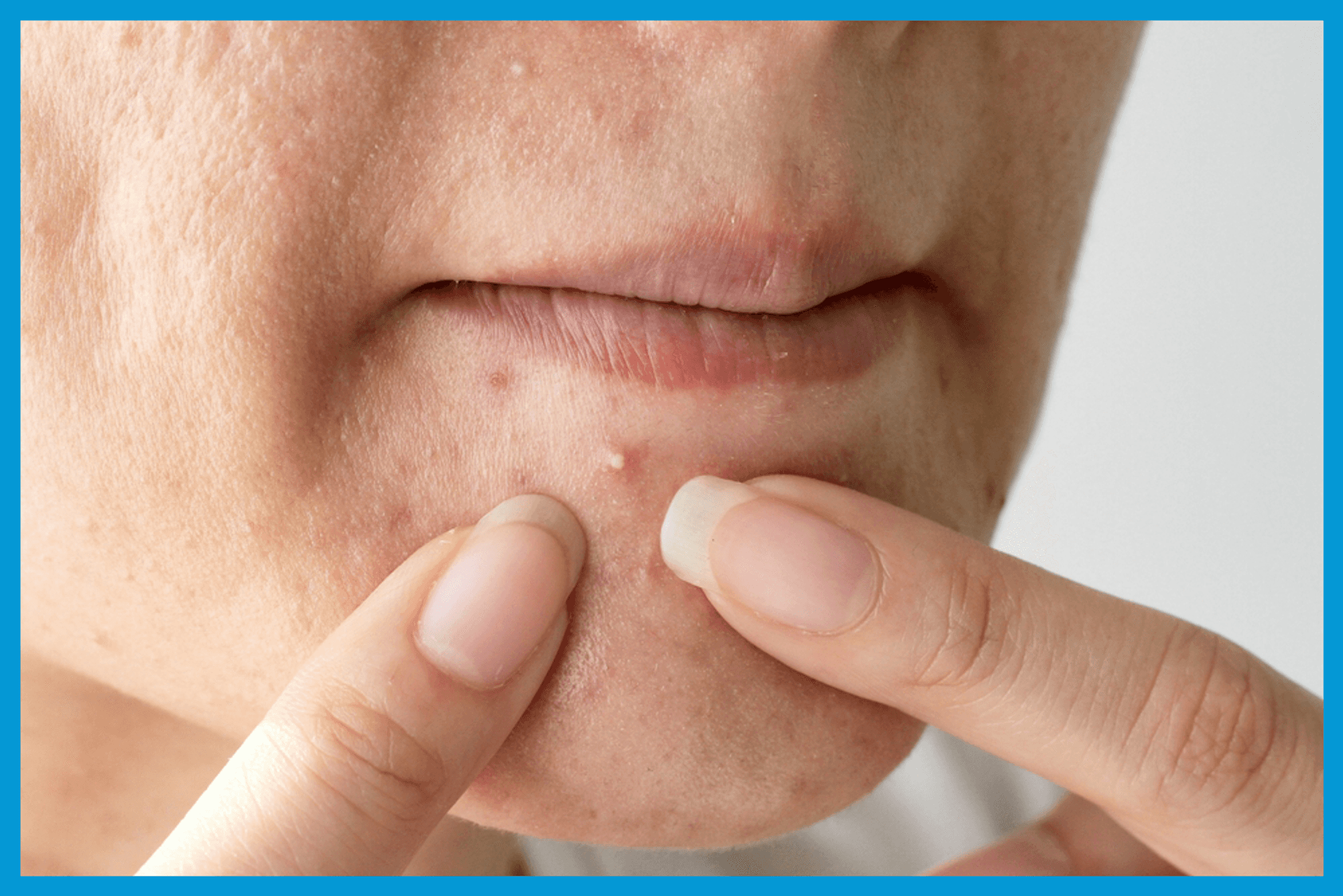 Creme gegen Pickel Vergleich & Test » Top 11 im Januar 2026